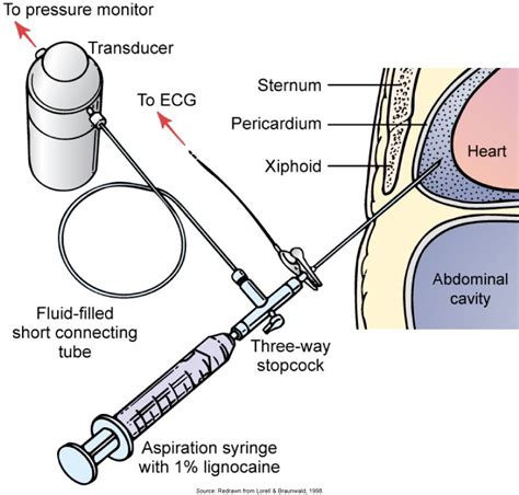 Pericardiocentesis Performed Under Sterile Conditions In Conjunction With Electrocardiogram And