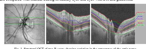 Figure 1 From Automated Boundary Detection Of The Optic Disc And Layer Segmentation Of The