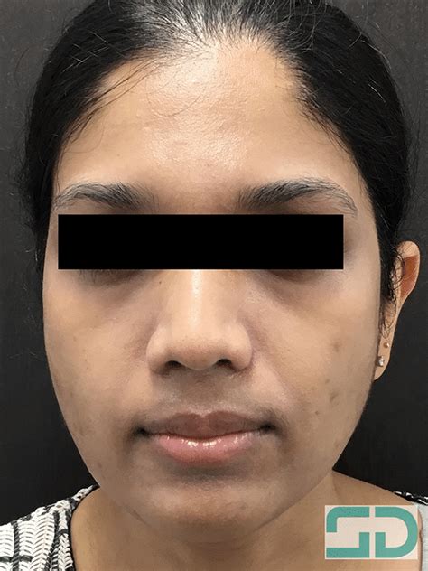 Pico Genesis Archives Summit Dermatology