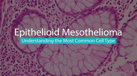 Malignant Mesothelioma Overview Of Malignant Mesothelioma