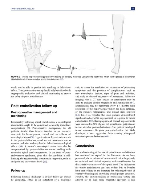Spinal Tumor Embolization Benefit For Surgical Resection Pdf