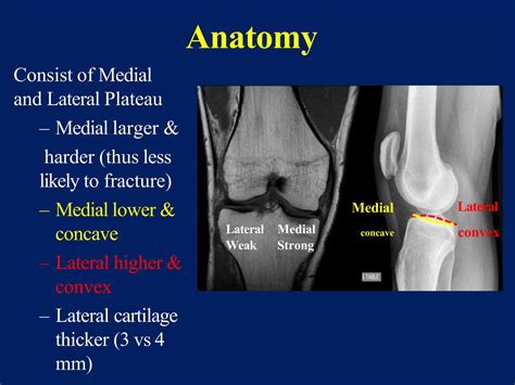 Proximal Tibia Fractures And Its Management Pptx