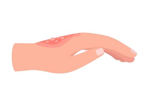 Premium Vector Burn Of Hand Human Skin First Aid For Fire Or Chemical