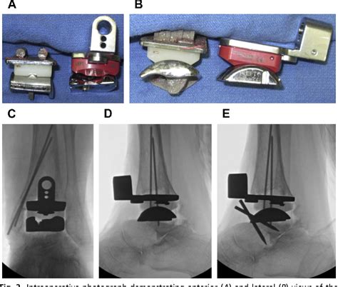 Figure 4 from The Salto Talaris XT Revision Ankle Prosthesis ...