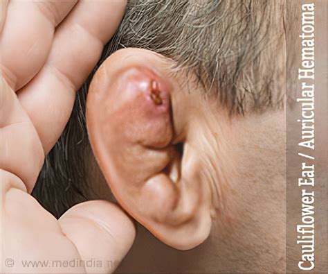Cauliflower Ear Surgery
