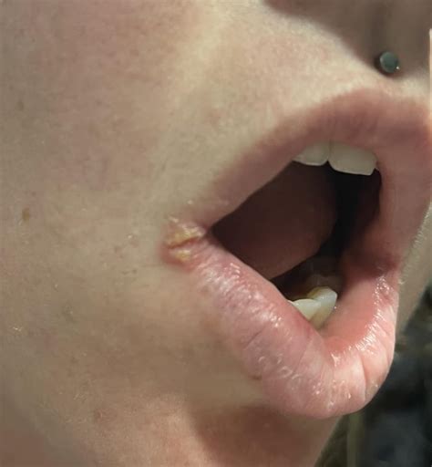 Angular Chelitis Help R Dermatologyquestions