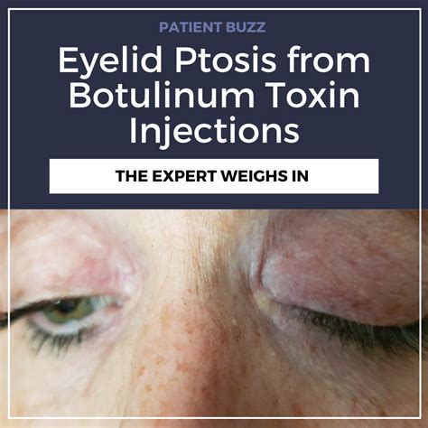 Botox Side Effects Droopy Eyelid