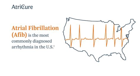 [video] Atricure Inc On Linkedin Act Against Afib