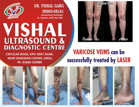Varicose Vein Laser Ablation