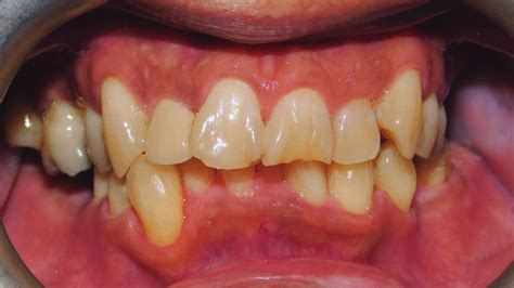 Class I Malocclusion Mutilated Dentition Deep Overbite Excessive Overjet Case Gallery