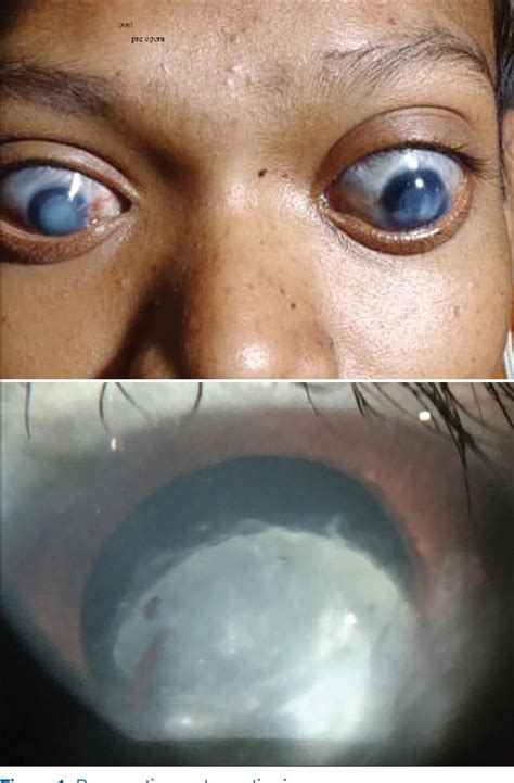 Marfan Syndrome Symptoms Eyes