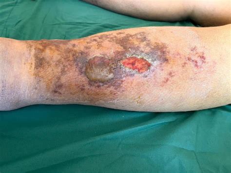 Terlipressin Induced Skin Necrosis In 3 Cases Should We Concern Pmc