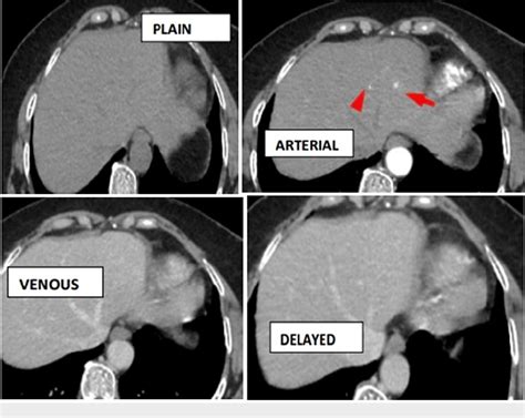 Figure 4 From The Role Of Computed Tomography Perfusion In Various