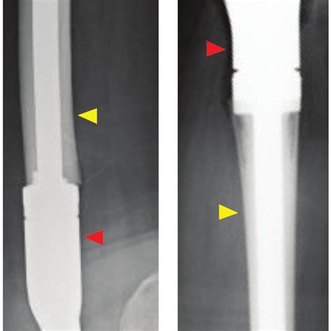 X Ray Imaging After Reconstruction Using The Kmls With Cemented Stem Download Scientific