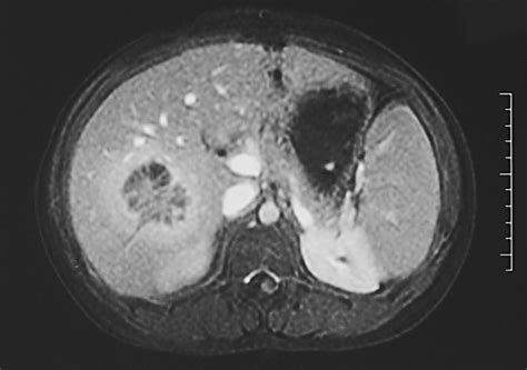 Ct And Mri Of Hepatic Abscess In Patients With Chronic Granulomatous