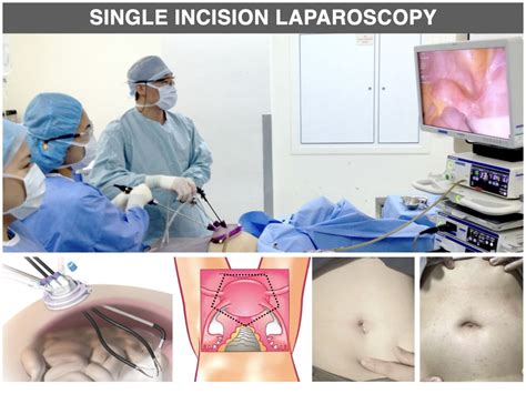 Hysterectomy Anthony Siow