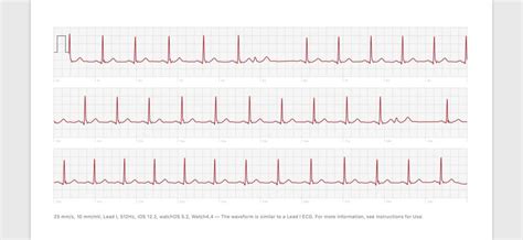 Ecg Eu Detected My My Mums Defect That Causes Her Heart To Skip A