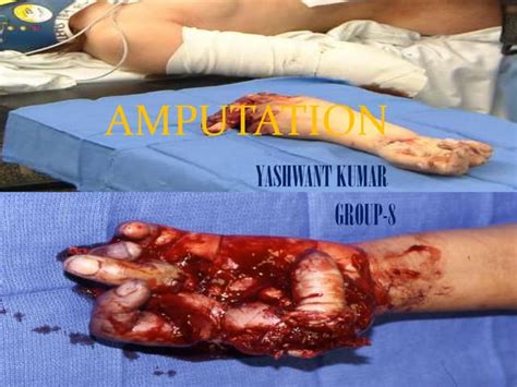 Amputation And Disarticulation Pptx