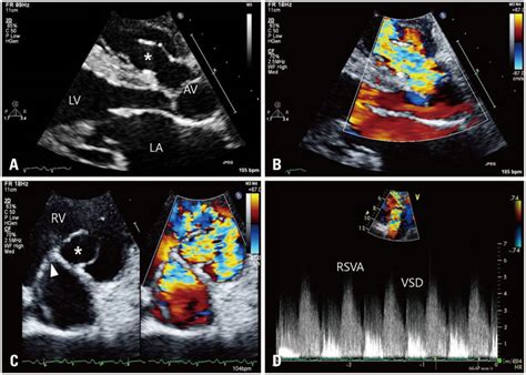 Windsock Deformity Meaning At Virginia Barr Blog