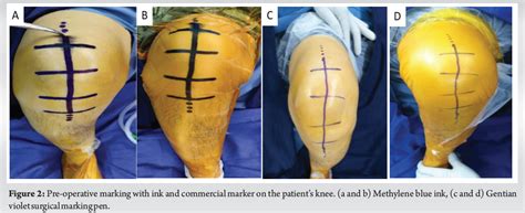 Cost Effective Skin Marking In Joint Replacement Surgery A Comparative