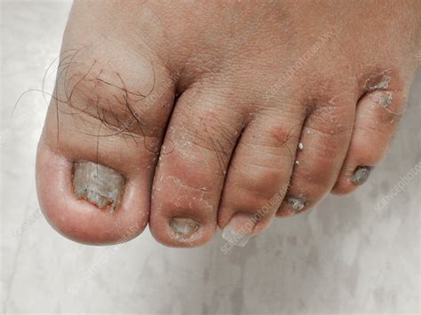 Athletes Foot Stock Image C0599186 Science Photo Library