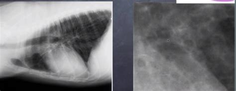 Imaging Bronchial And Interstitial Pattern Flashcards Quizlet