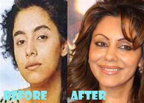 Gauri Khan Plastic Surgery Before And After Pictures Lovely Surgery