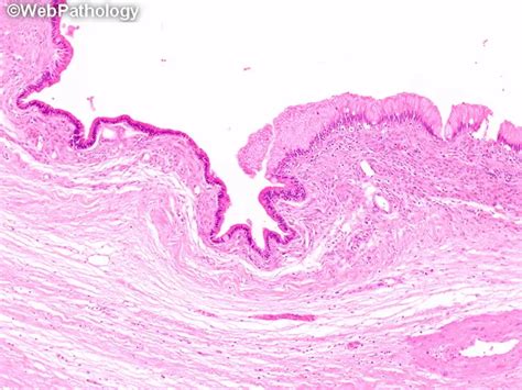 Mucinous Cystic Neoplasm