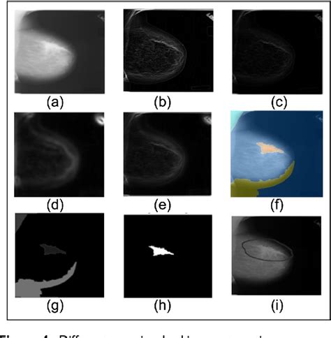 Figure 1 From Automated Multimodal Segmentation Of An Abnormal Breast