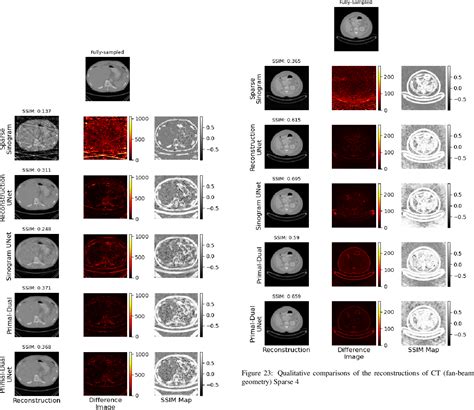 figure 1 from sinogram upsampling using primal dual unet for