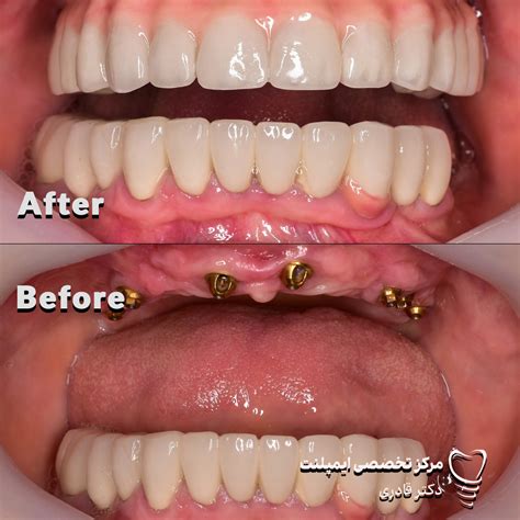 ایمپلنت دیجیتال چیست؟ مراحل درمان و قیمت