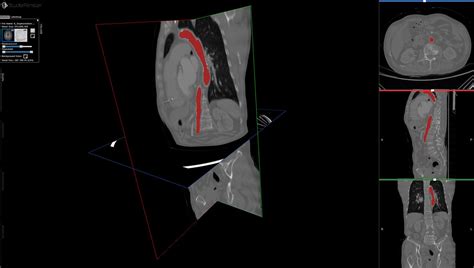 Sega Segmentation Of The Aorta Medical Imaging