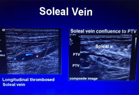 Soleal Vein