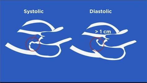 Pocus Flashcards Quizlet