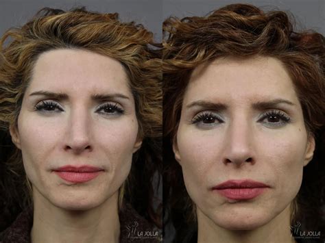 Liquid Facelift Before After Gallery Patient