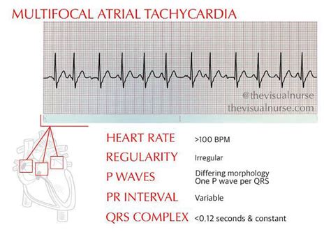 Multifocal Atrial Tachycardia Medizzy