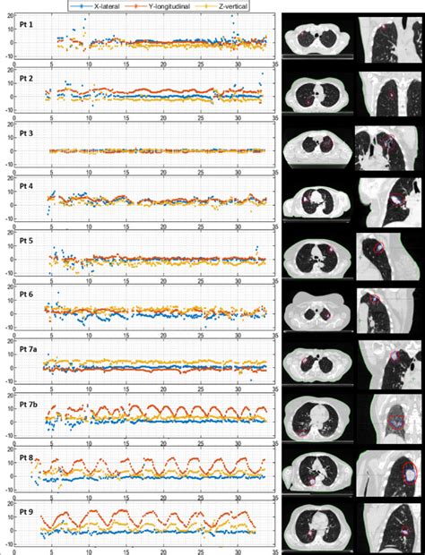 Markerless Real Time 3 Dimensional Kv Tracking Of Lung Tumors During Free Breathing Stereotactic