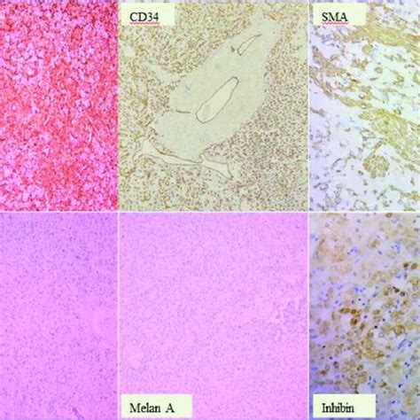 A F Immunohistochemistry Staining Vimentin Cd 34 Sma Hmb 45