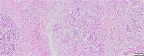 Human Pancreas Cancer Adenocarcinoma Ffpe Sections Human Pancreas Cancer Adenocarcinoma Ffpe Sections