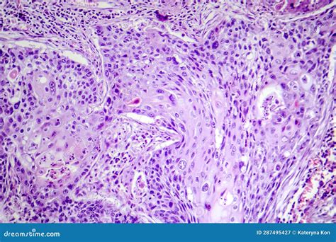 Squamous Cell Carcinoma Of The Lung Light Micrograph Stock Image Image Of Respiratory