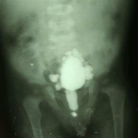 Voiding Cystourethrogram Showing Dilatation And Elongation Of Posterior Download Scientific