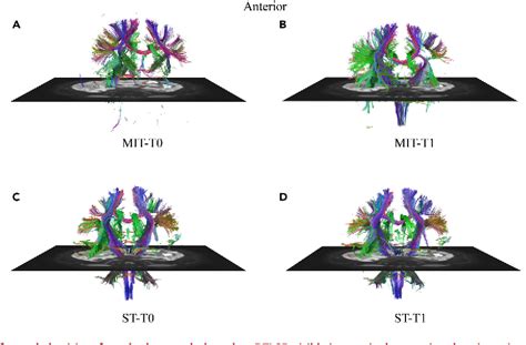 Figure 2 From Melodic Intonation Therapy For Non Fluent Aphasia After Stroke A Clinical Pilot