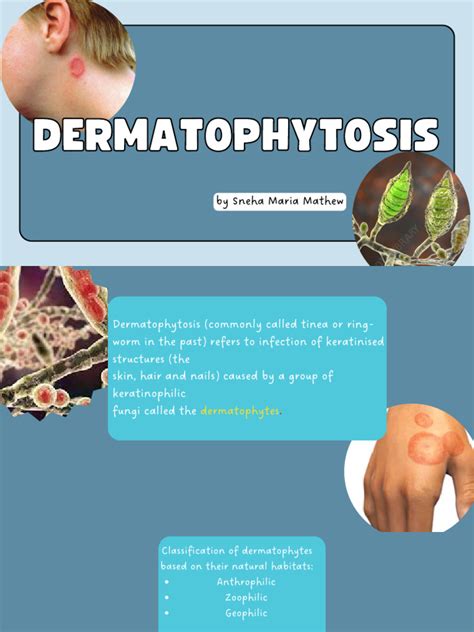 Dermatophytes 20240314 214707 0000 Download Free Pdf Clinical Medicine Immunology