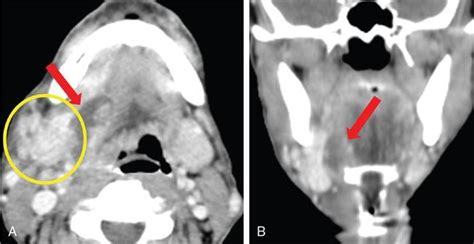 Imaging Of Submandibular Space Radiology Key