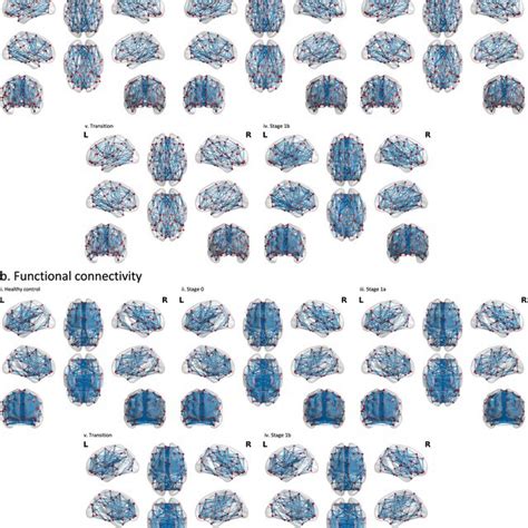Binarized Connectivity Matrices From Each Stage Of Smi Risk Depicted On