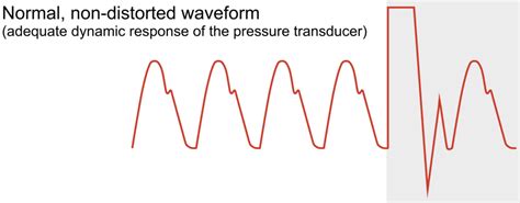 Damping And Arterial Lines Rebel Em Emergency Medicine Blog