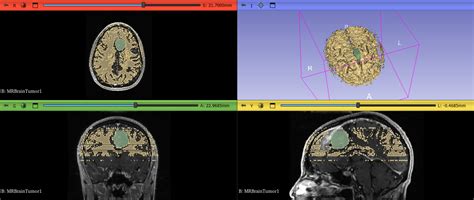 Github Shoaibgibrain Tumor Segmentation