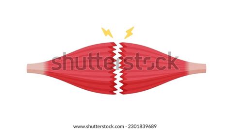 Muscle Rupture Vector Illustration Complete Tear Stock Vector Royalty Free 2301839689