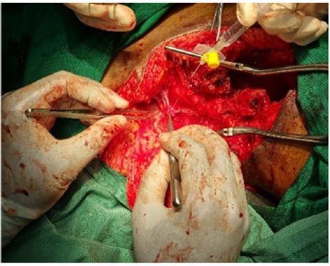 Recipient Thoracodorsal Neurovascular Bundles With Topical Heparin In Download Scientific