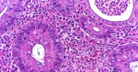 Transforming Ulcerative Colitis Trial Enrollment